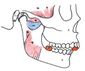 Why Anterior Deprogrammers Should Be Used In Every Practice - The ...