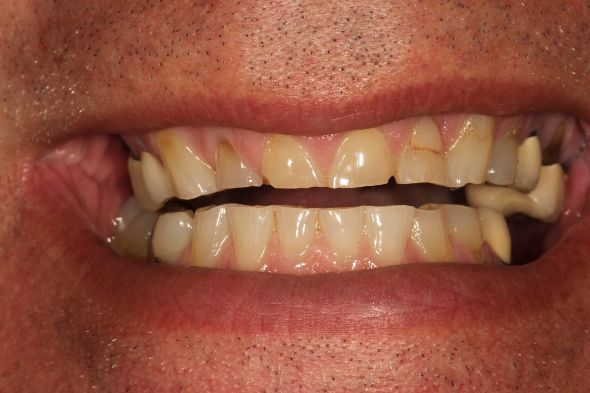 Is Wear on Patients' Teeth Normal? - The Dawson Academy